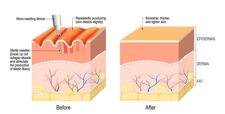 Microneedling with Exosomes Before and After: What to Expect