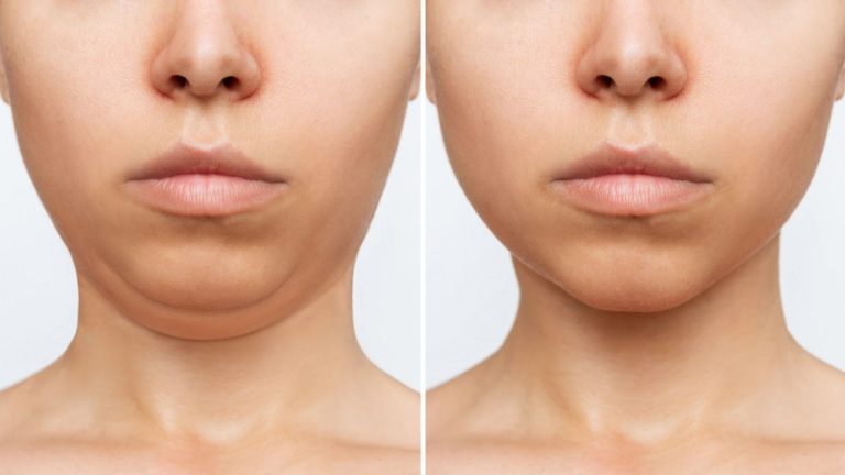 Chin Filler Migration: Causes, Signs, Prevention, and Correction