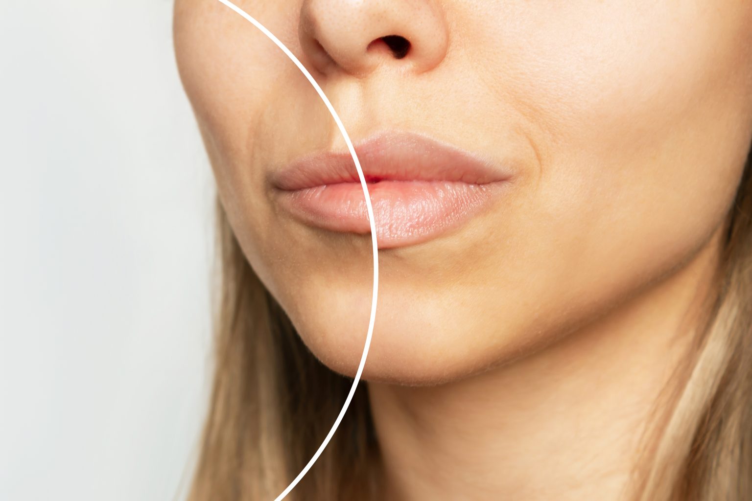 Juvederm Vertical Lip Lines Anti-Aging Treatment